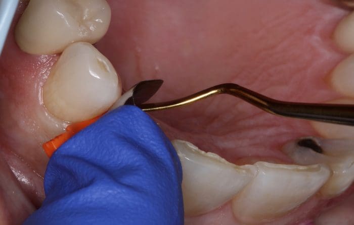 Case Report: Anterior Matrix Systems Essential to Provide Proper ...